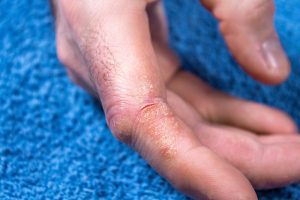 Rogowiec skóry, dłoni, stóp – diagnostyka i leczenie | Diag.pl